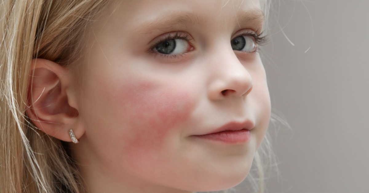 Quinta malattia: sintomi, contagio e cura